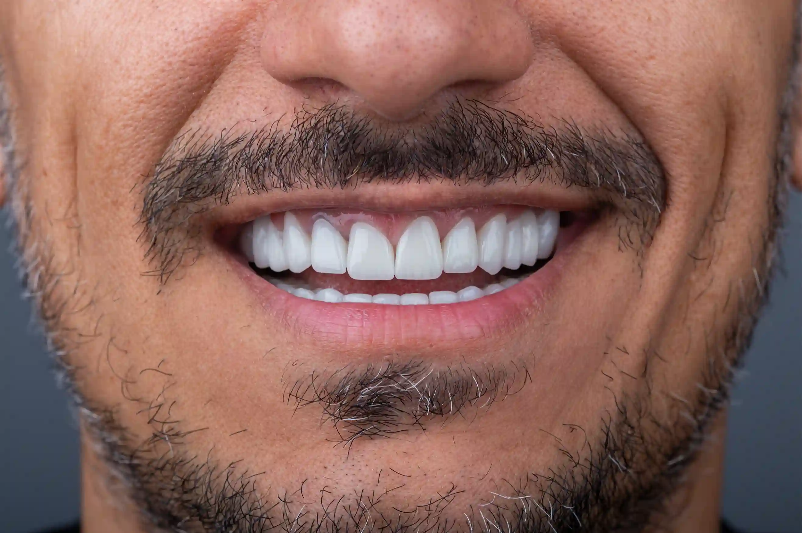 Hollywood Smile Turkey: Celebrity Smile Makeover of Comedian Eduard ...